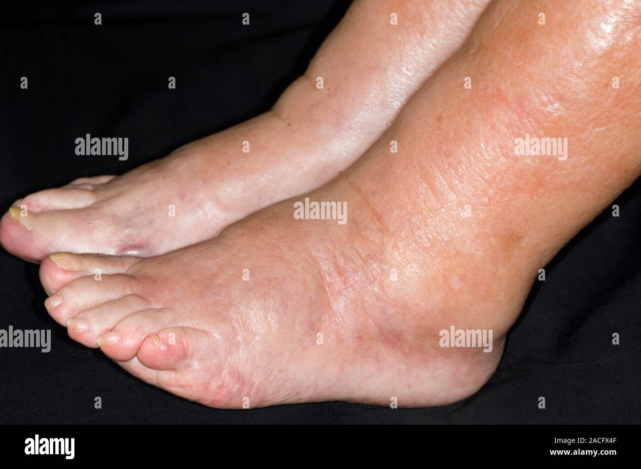 Oedema (swelling) of the ankles of the legs of an adult female patient ...