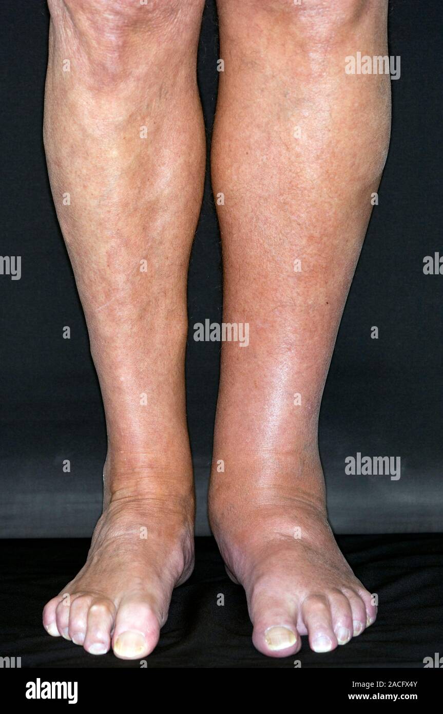 Deep vein thrombosis in the leg of an adult woman, showing swelling of ...