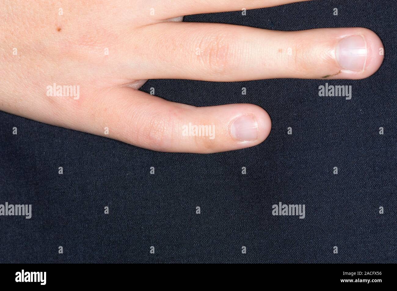 Angulation (bend) in the finger of an adult male following fractures ...