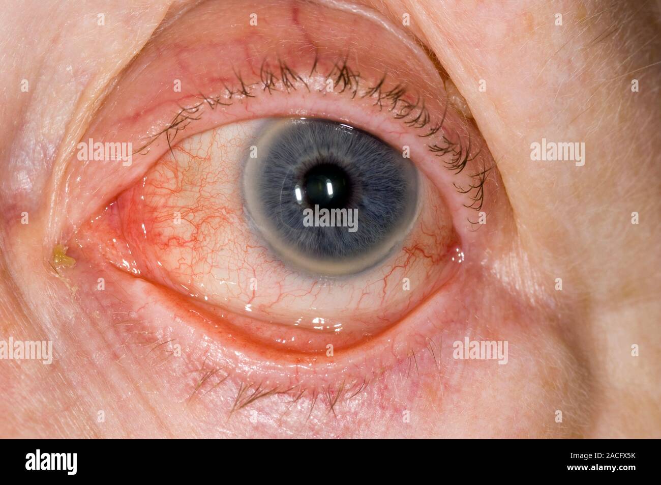 Chronic blepharitis of the eye of an elderly patient, showing an ...