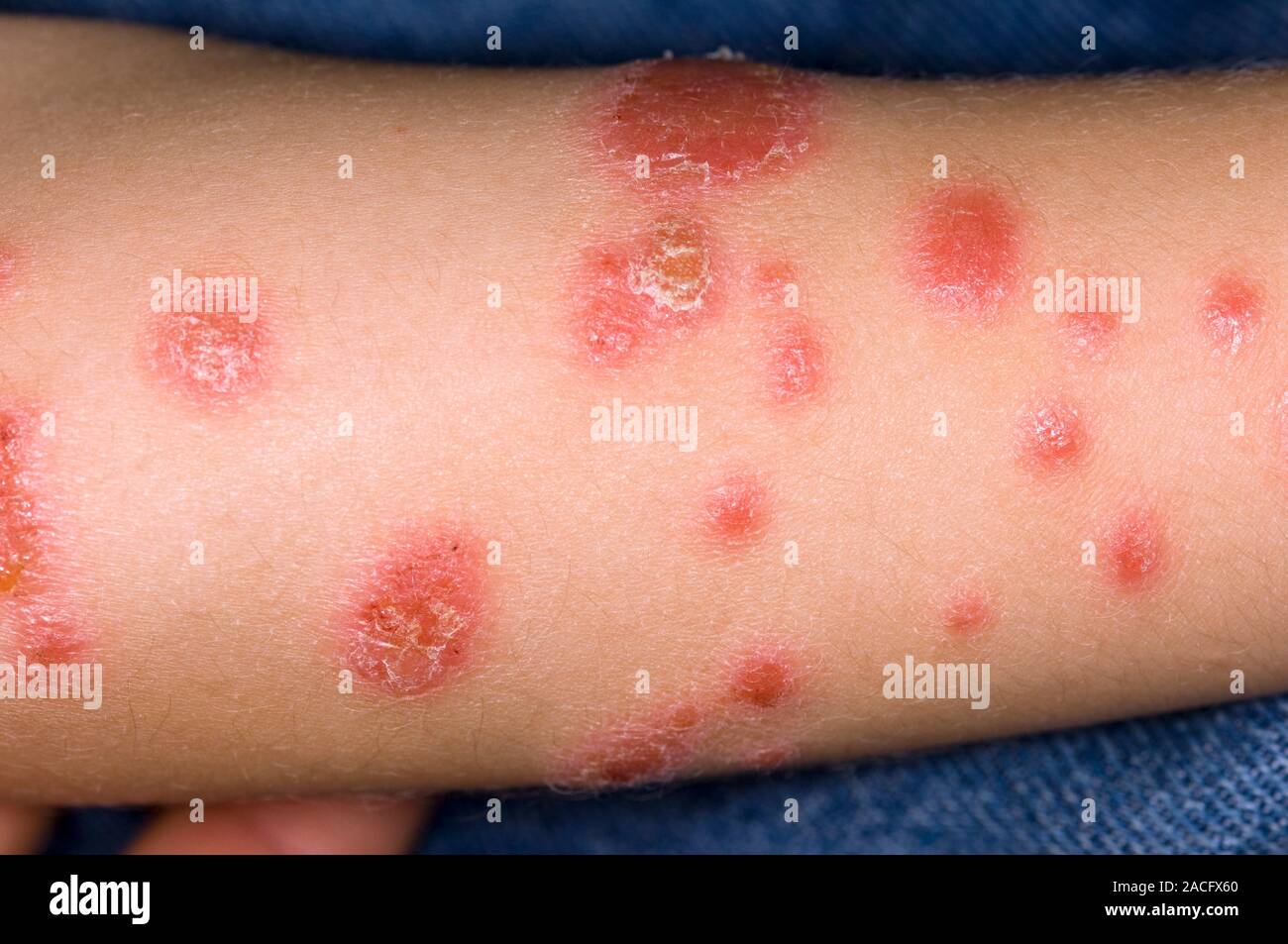 Psoriasis on the skin of the arm of a young boy aged 3 years. Psoriasis ...