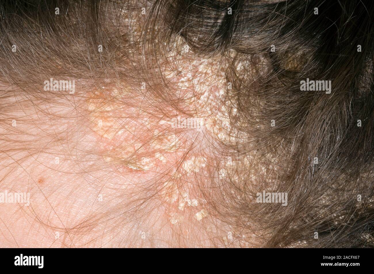 Psoriasis on the skin of the scalp of a female patient. Psoriasis is a ...