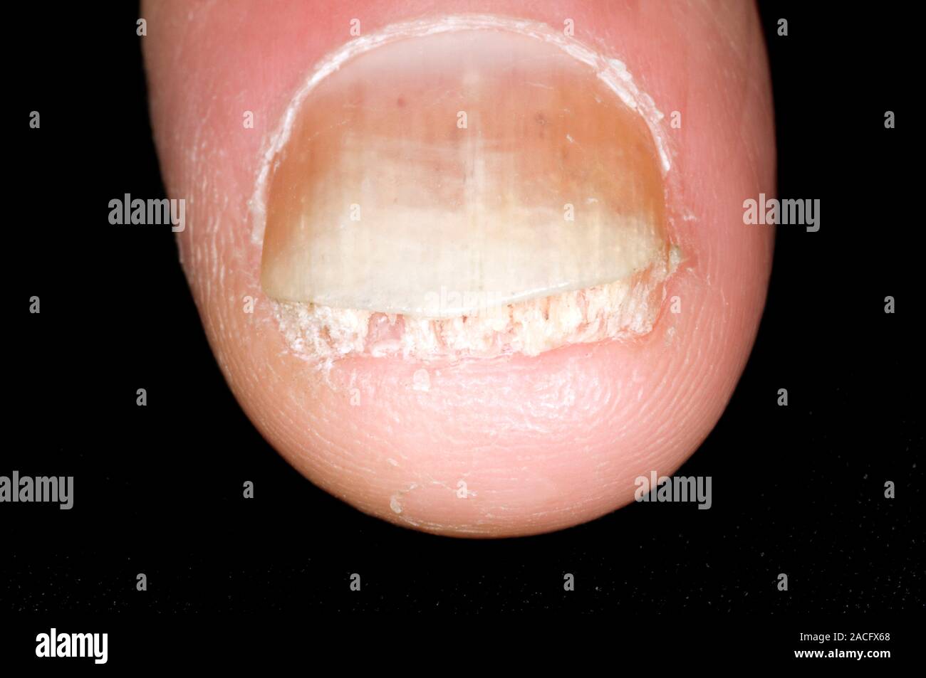 Psoriasis affecting a finger nail of an adult female patient. This skin ...