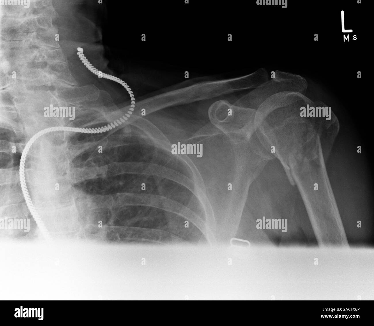 X-ray of the shoulder of an elderly patient, showing a comminuted ...