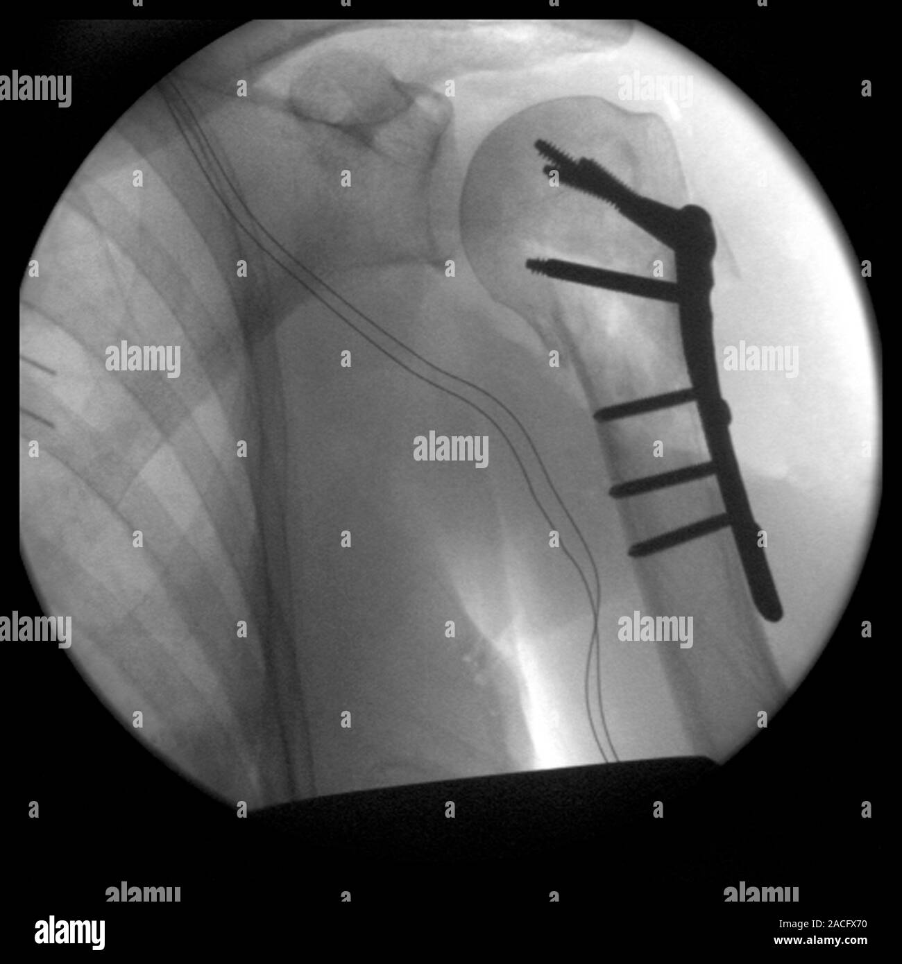 X-ray of the shoulder of an elderly patient, showing a metal plate ...