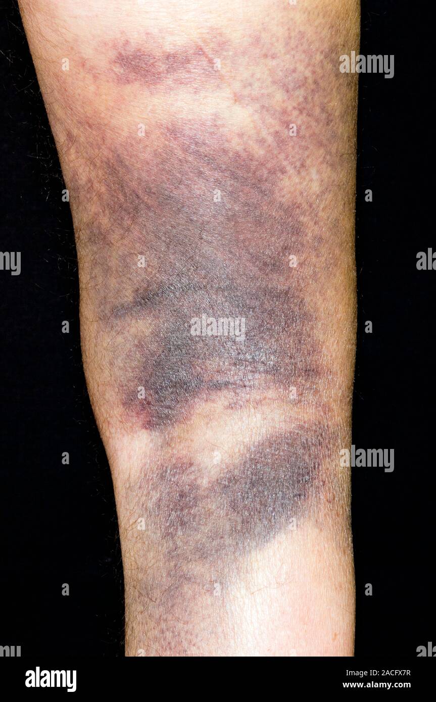 Bruising (haematoma) on the leg of an adult patient, seven days after a ...