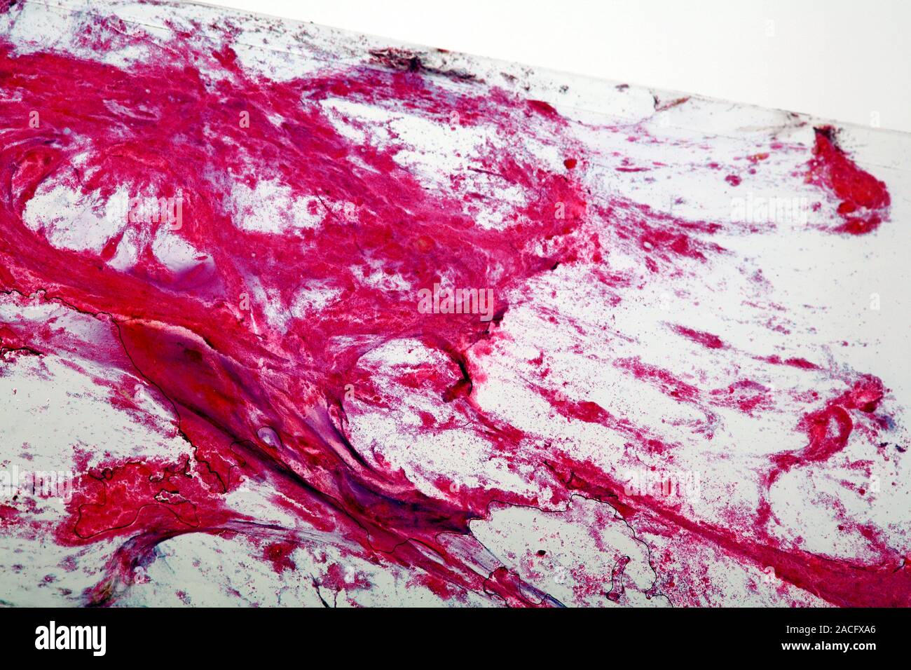 Cervical smear slide. Close-up of a stained cervical smear histological ...