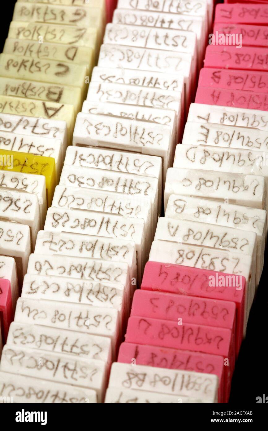 Pathology specimens. Collection of pathology specimens in wax ...