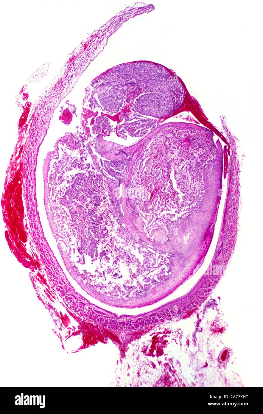 Cancerous kidney tumour. Light micrograph of a section through a ...