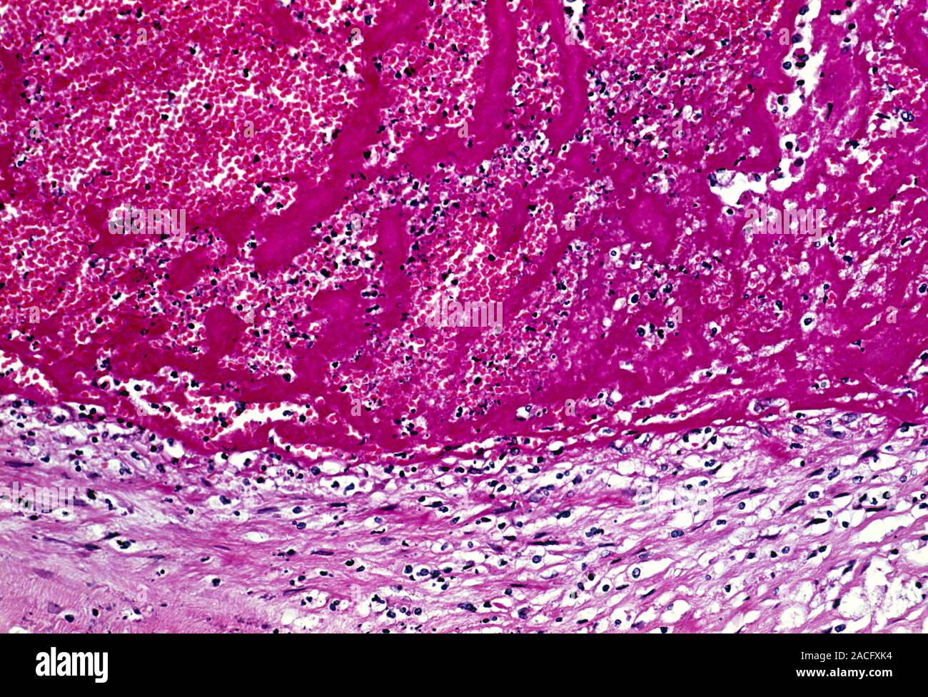 Developing thrombus. Light micrograph of a section through an artery ...