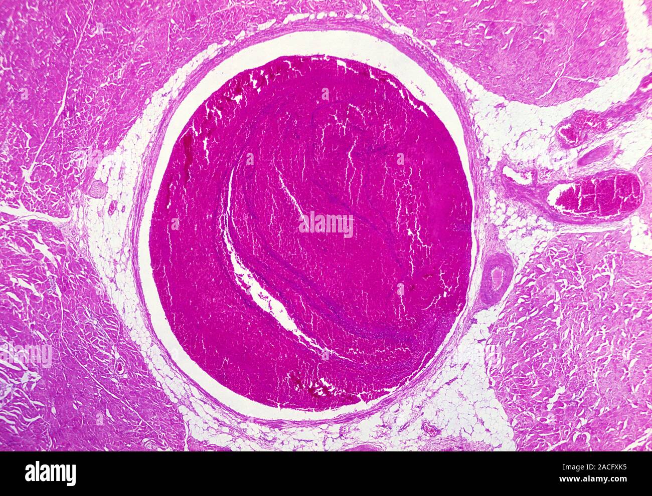 Deep vein thrombosis. Light micrograph showing a blood clot (thrombus ...
