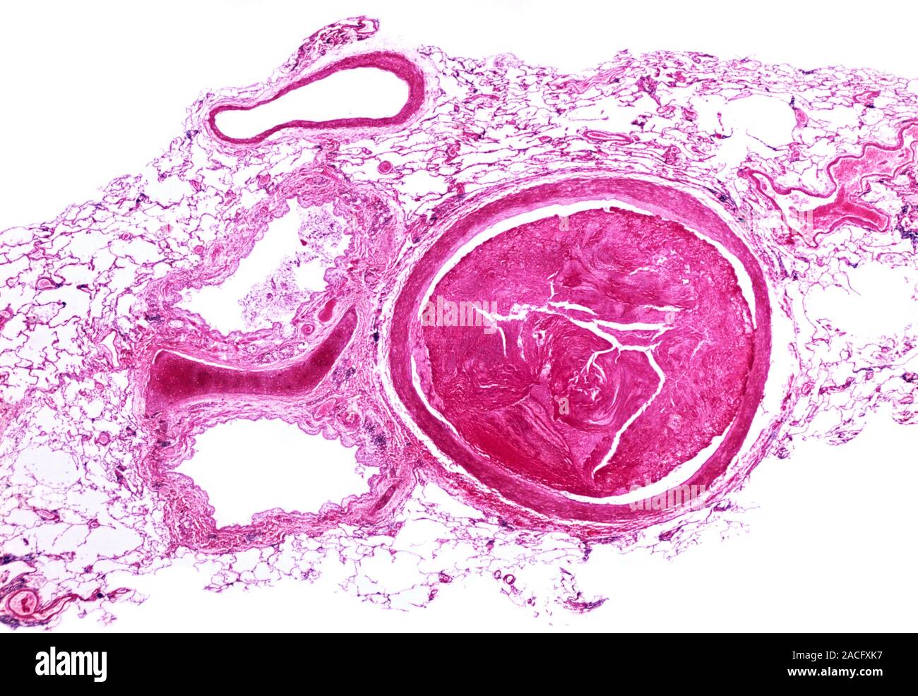 Pulmonary embolism. Light micrograph showing a blood clot (round, dark ...