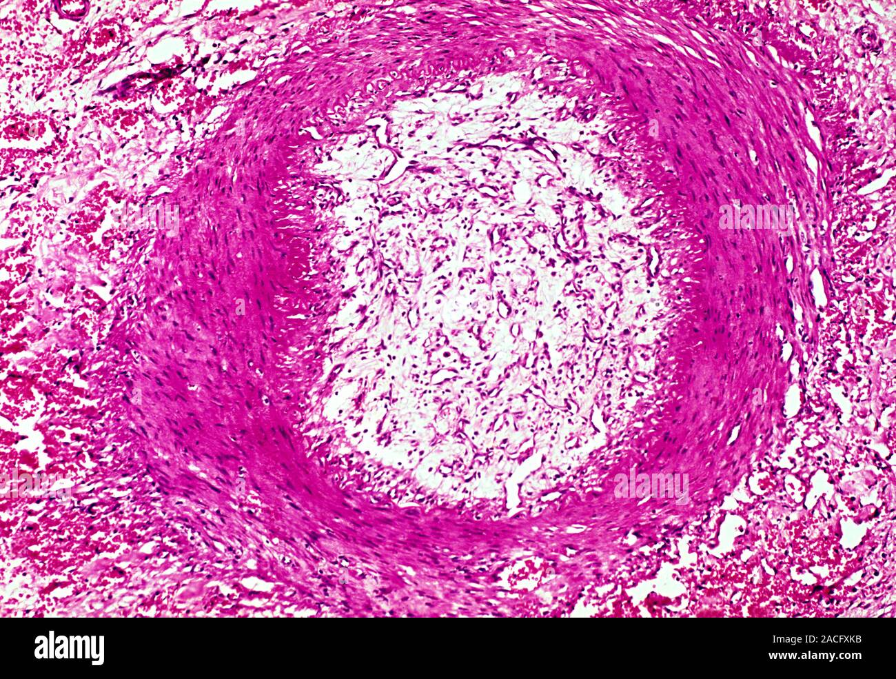 Formation of vessels in a blood clot. Light micrograph showing new ...
