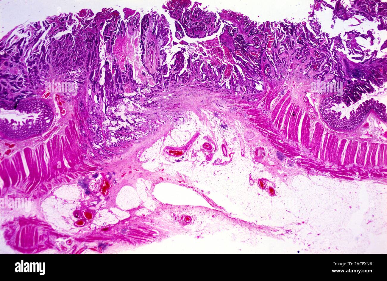 Colon cancer. Light micrograph of tissue from a colon in a case of ...