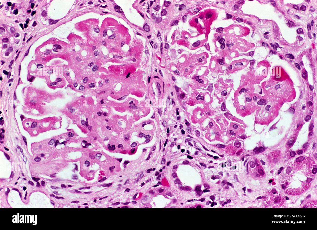 Kidney membrane disease. Light micrograph of tissue from a kidney in a ...