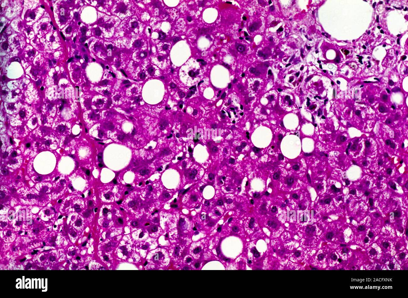 Chronic hepatitis. Light micrograph of tissue from a liver in a case of ...