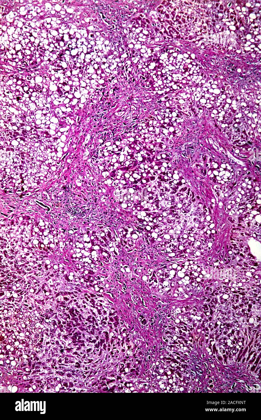 Alcoholic cirrhosis. Light micrograph of tissue from a liver in a case ...