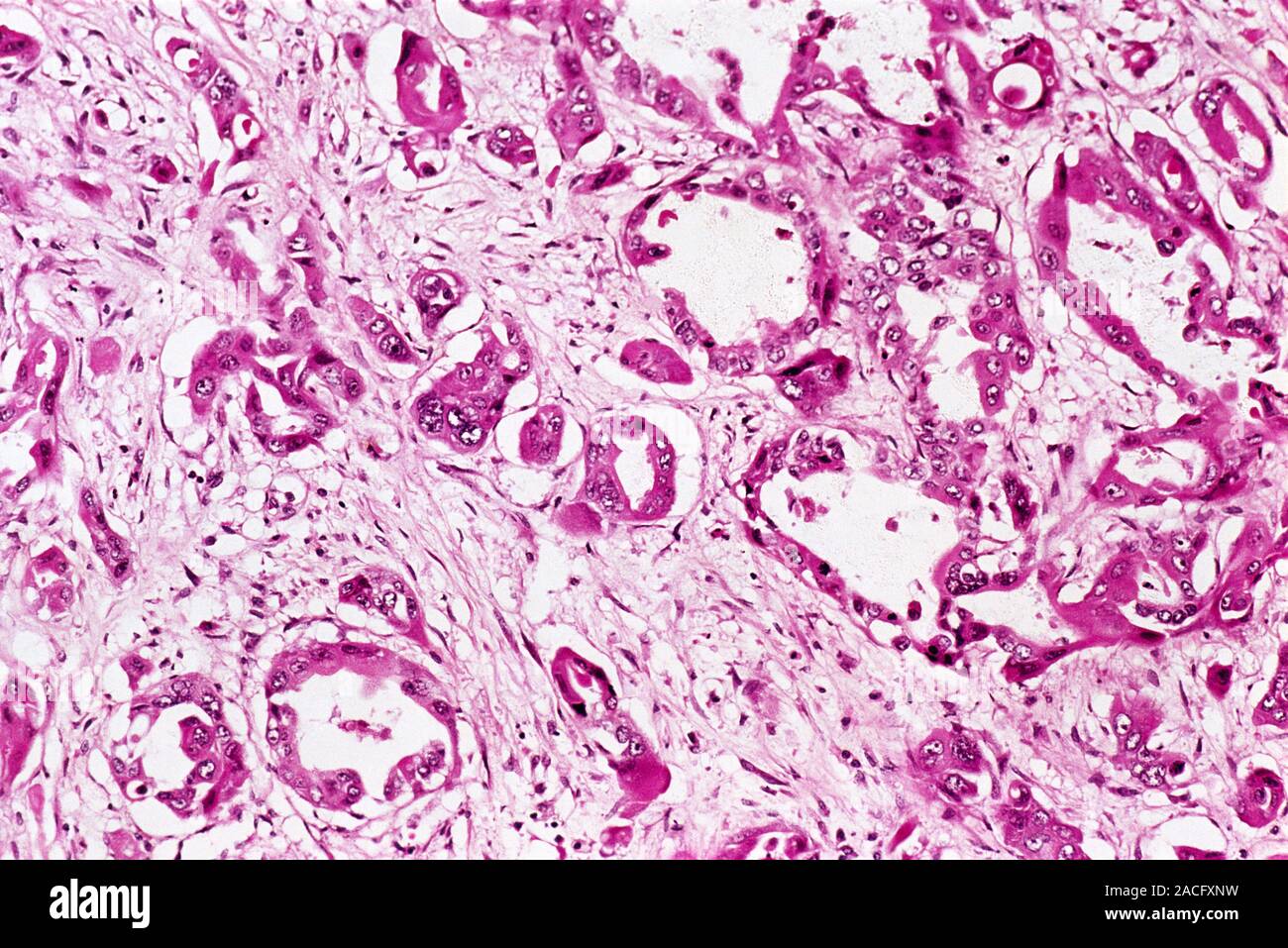 Pancreatic cancer. Light micrograph of tissue from a pancreas in a case ...