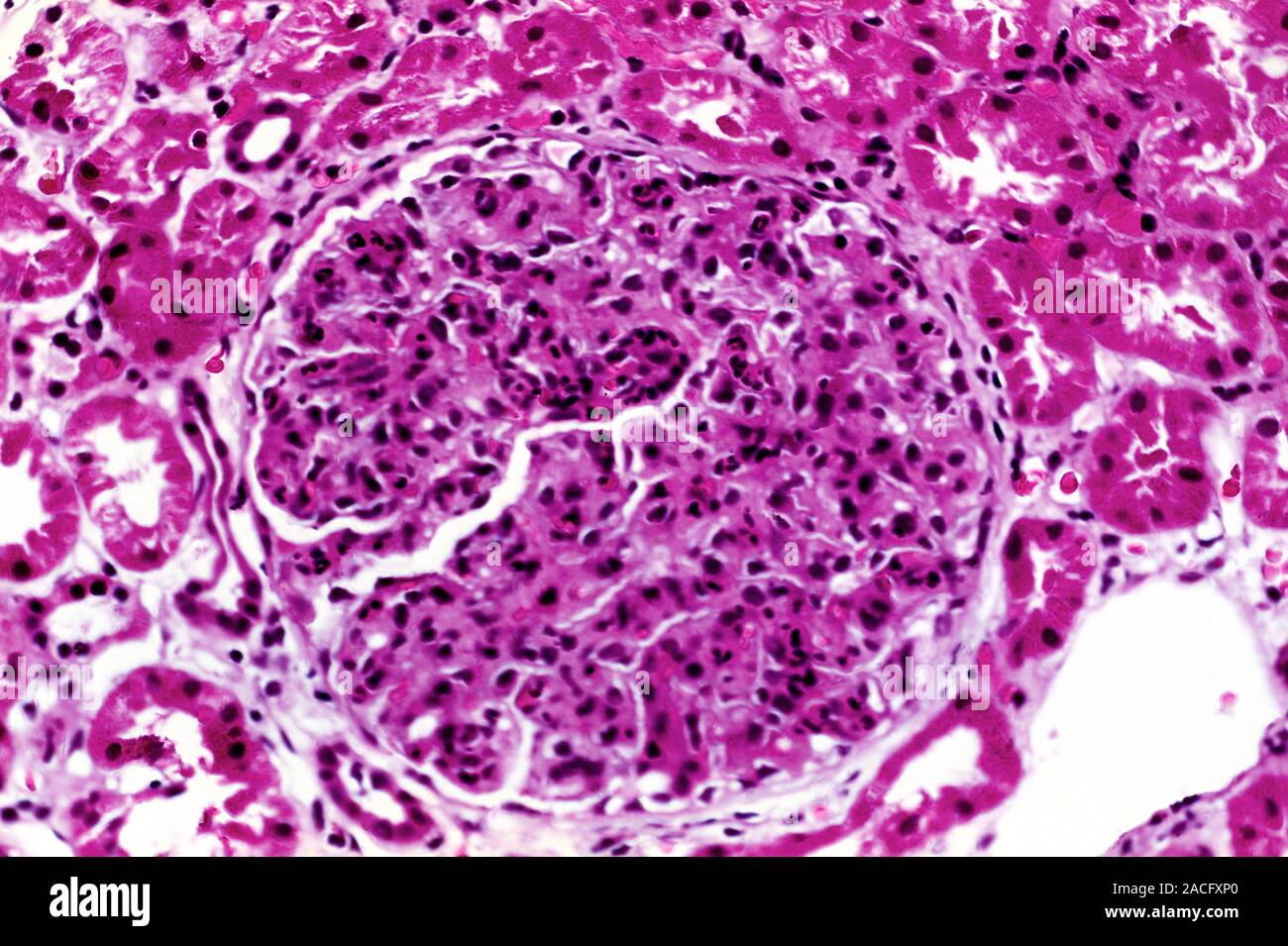 Glomerulonephritis. Light micrograph of tissue from a kidney in a case ...