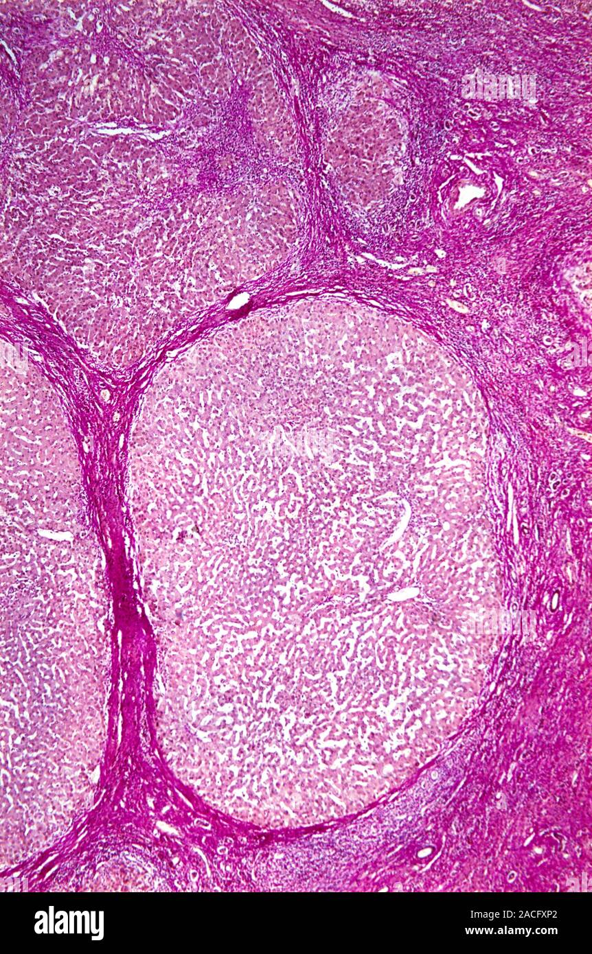 Cryptogenic cirrhosis. Light micrograph of tissue from a liver in a ...
