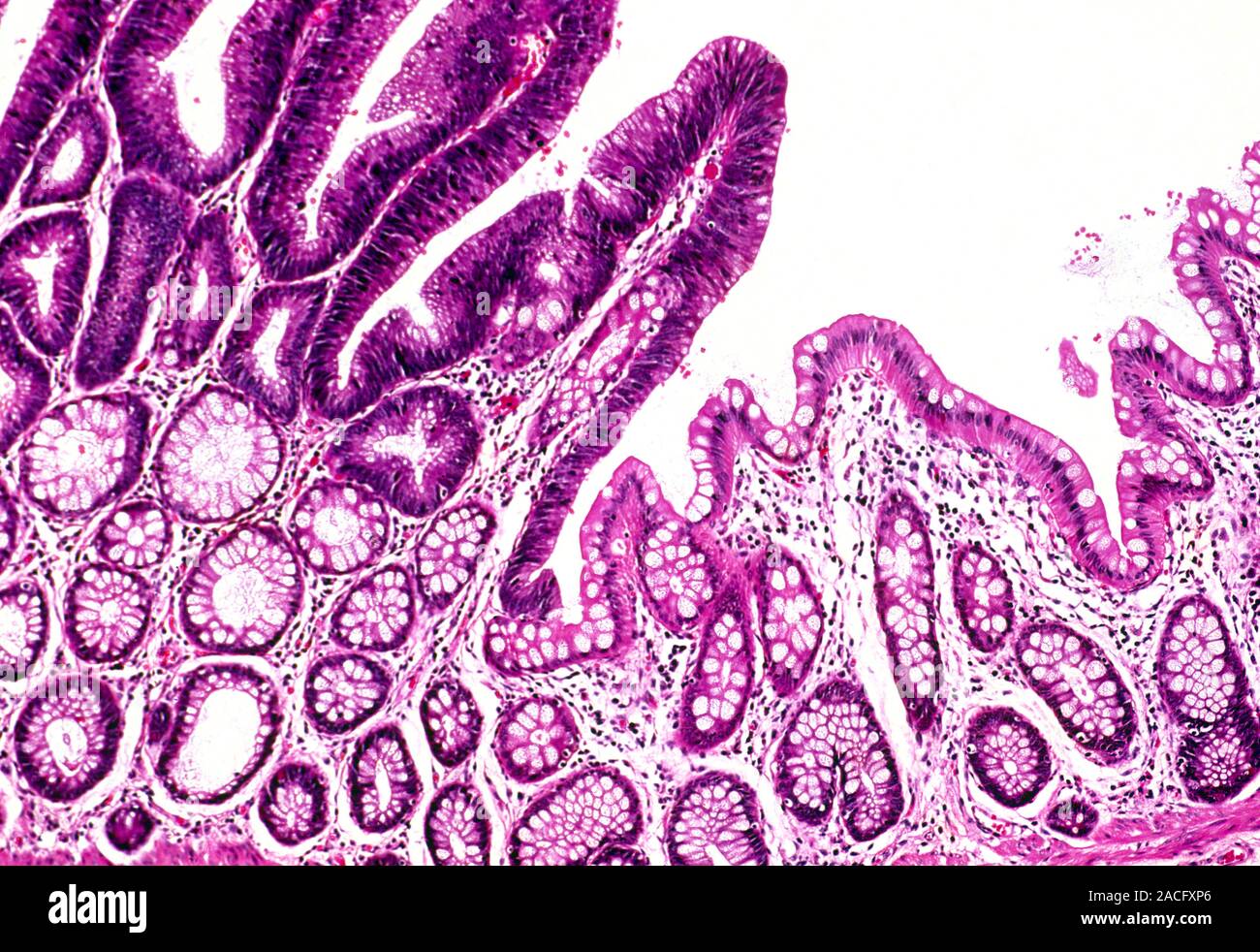 Non-cancerous intestinal growth. Light micrograph of a section through ...