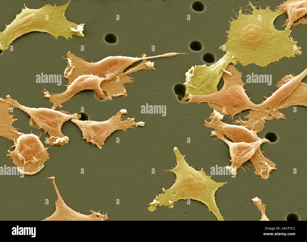 Cancer cell culture, coloured scanning electron micrograph (SEM). The ...