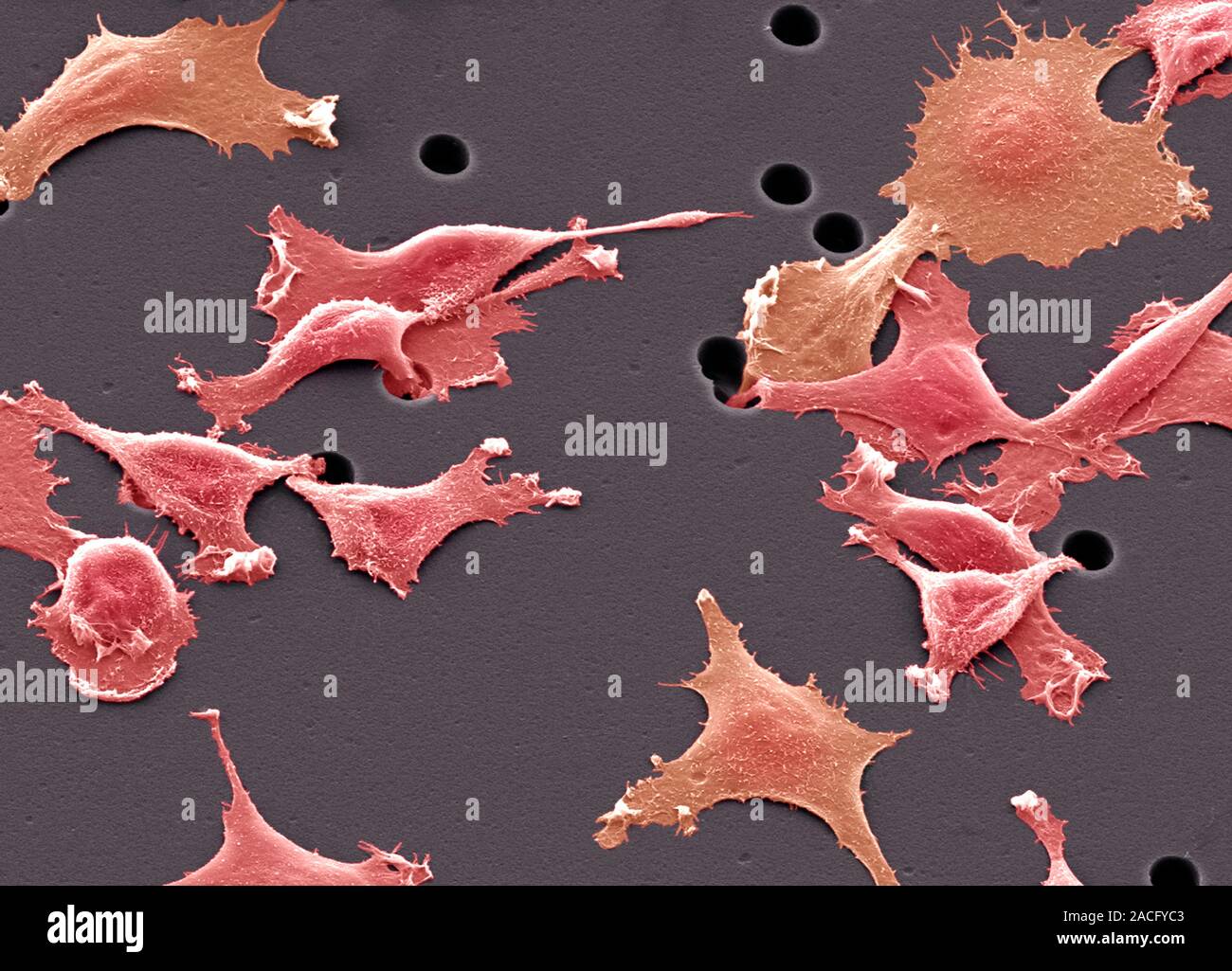 Cancer cell culture, coloured scanning electron micrograph (SEM). The ...