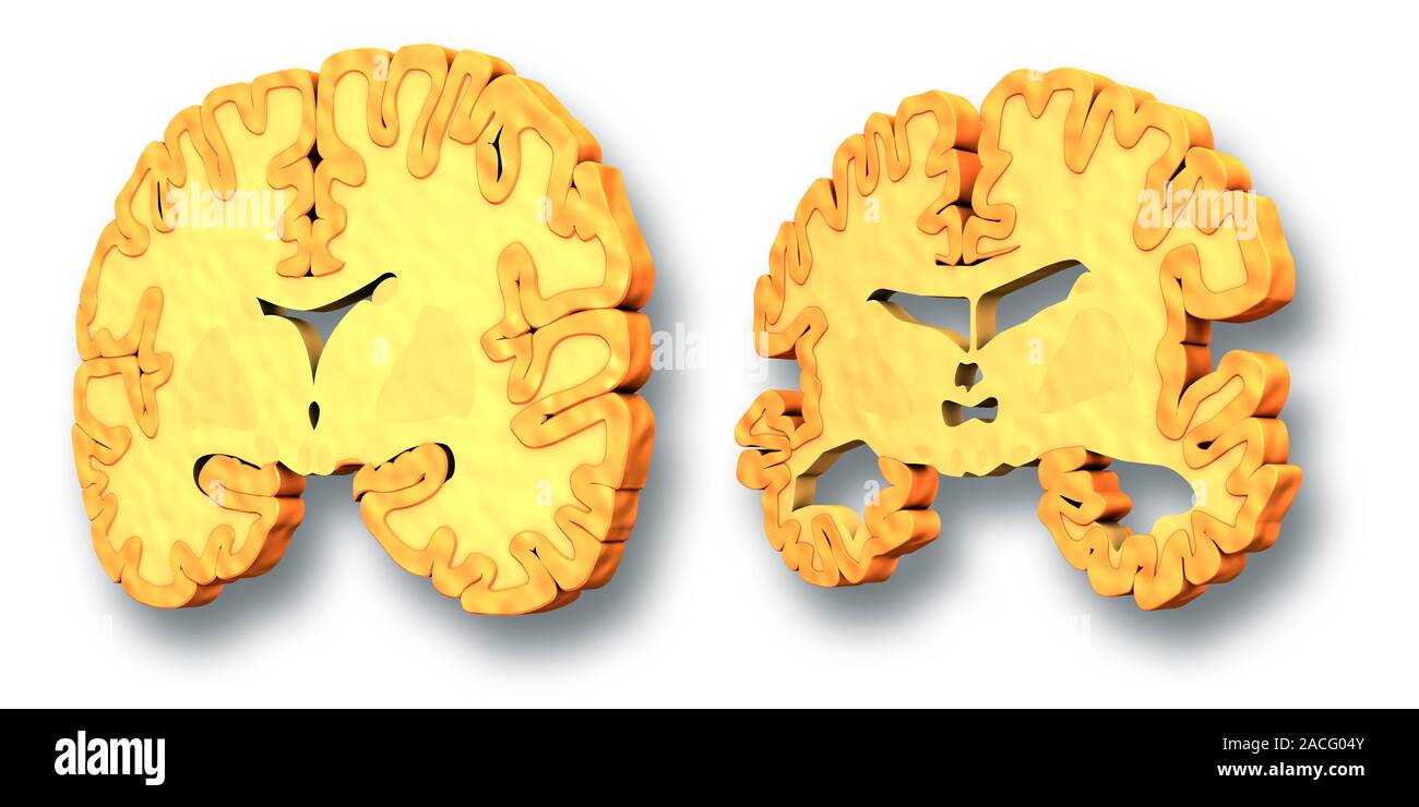 Alzheimer's disease. Computer artwork of coronal (vertical) slices ...