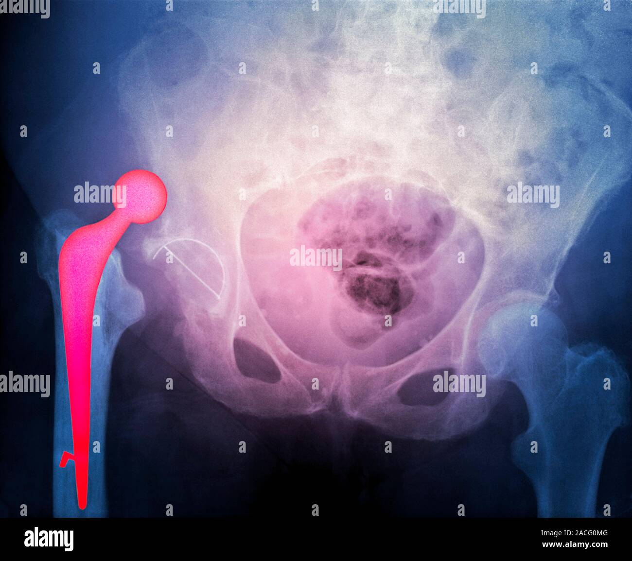 Coloured X-ray (front view) of the pelvis of a patient, showing the ...
