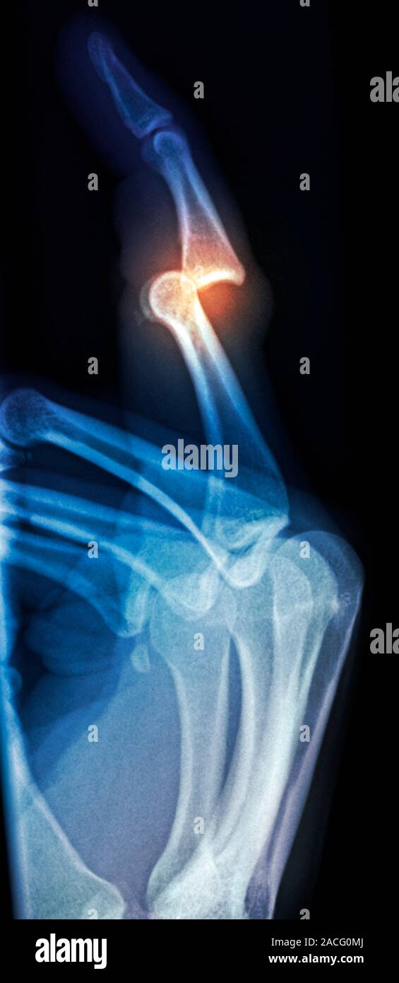 Coloured X-ray (side view) of the hand of a patient, showing ...