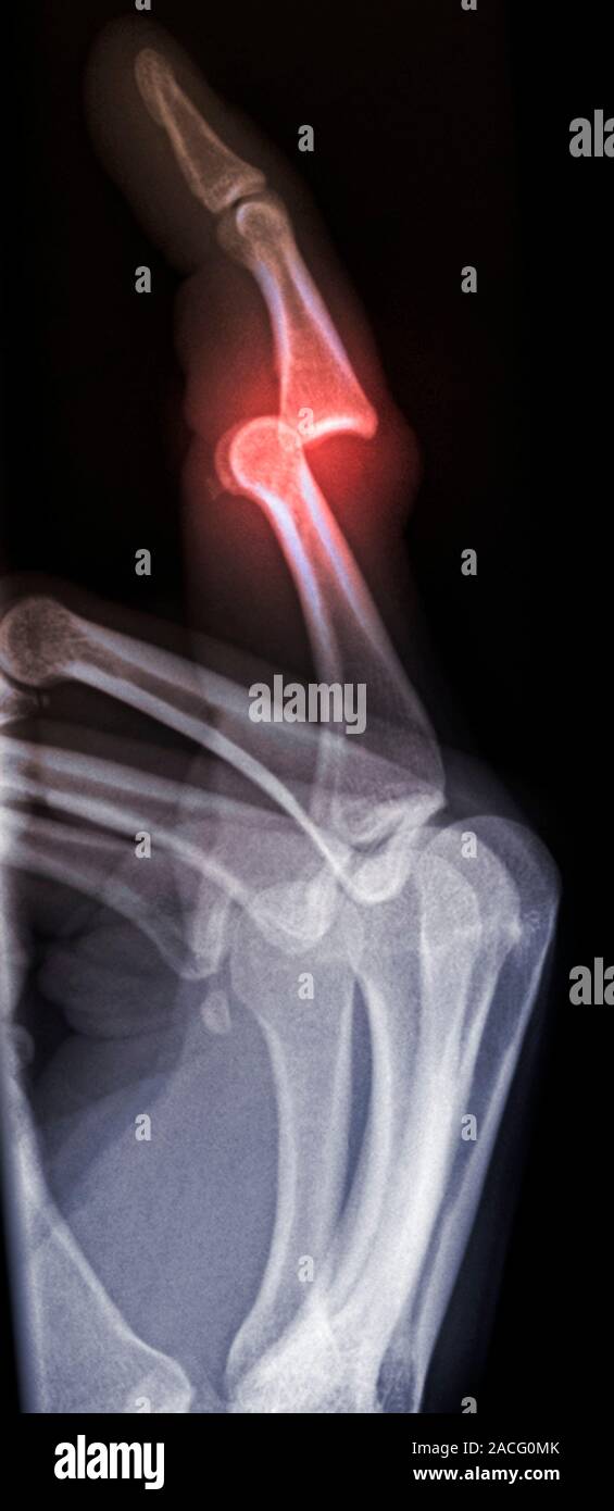 Coloured X-ray (side view) of the hand of a patient, showing ...