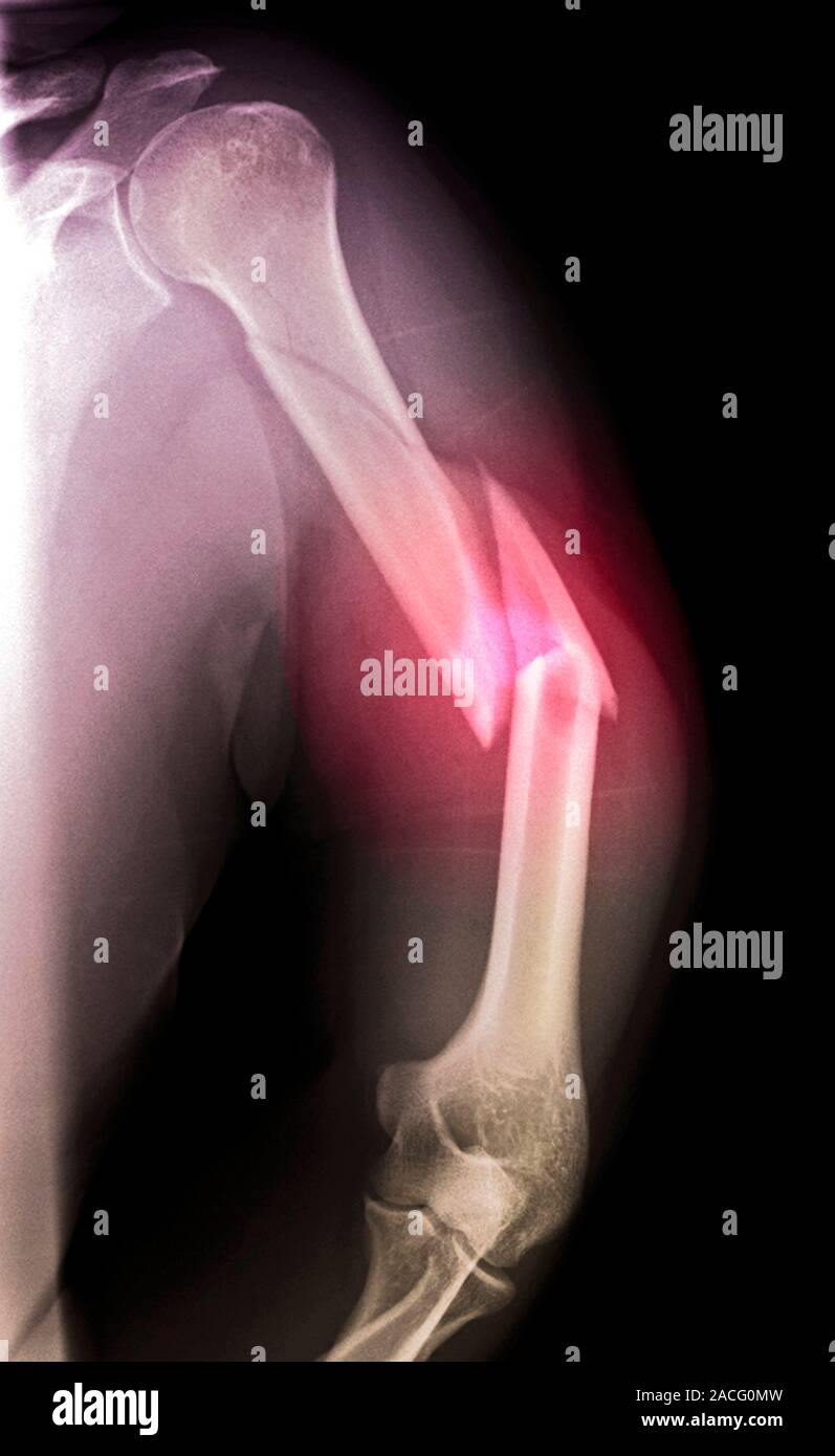 Coloured X-ray (front view) of the arm of a patient, showing a ...