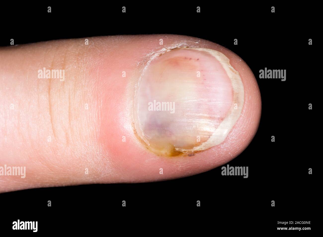 Infected bruise (haematoma) under the fingernail (subungual) of an ...
