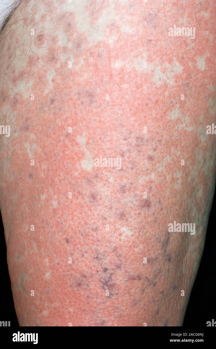 Allergic skin reaction to a drug (trimethoprim) given for cystitis ...