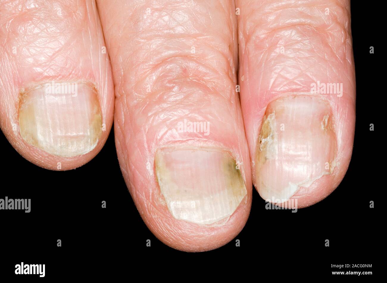 Fungal nail infection on the fingers of the hand of an adult patient ...