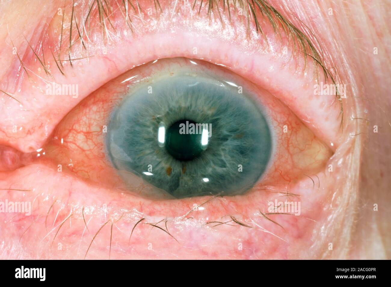 Close-up of the eye of an elderly patient, showing acute anterior ...