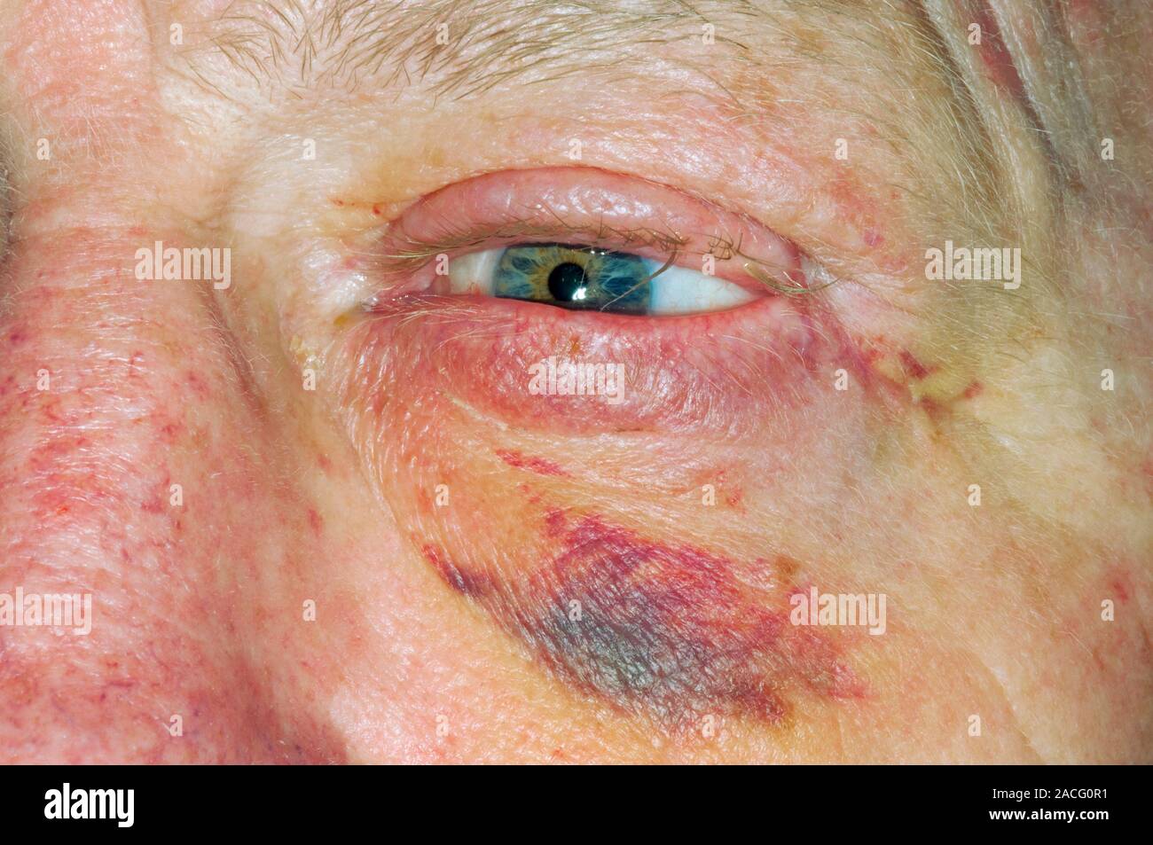 Close-up of the bruised eye of an elderly male cancer patient, whose ...