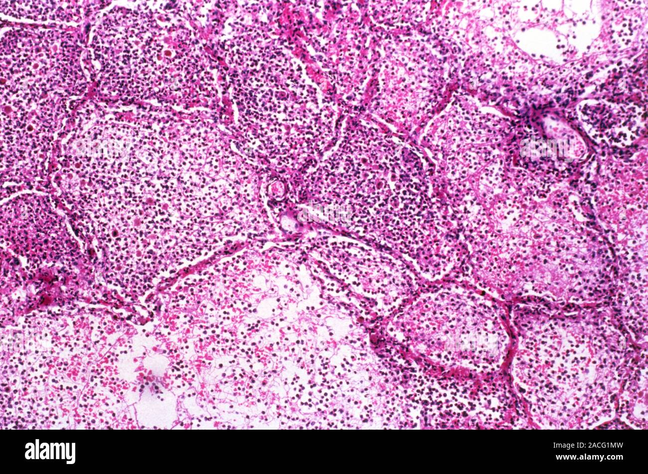 Bronchopneumonia. Light micrograph of a section through lung tissue ...