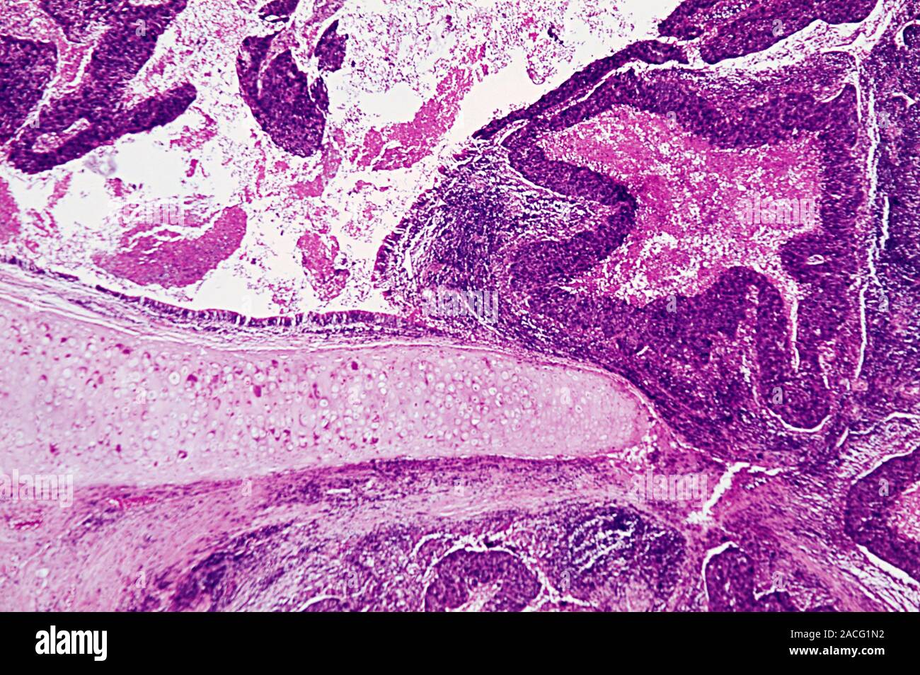 Lung cancer. Light micrograph of a section through a lung with small ...