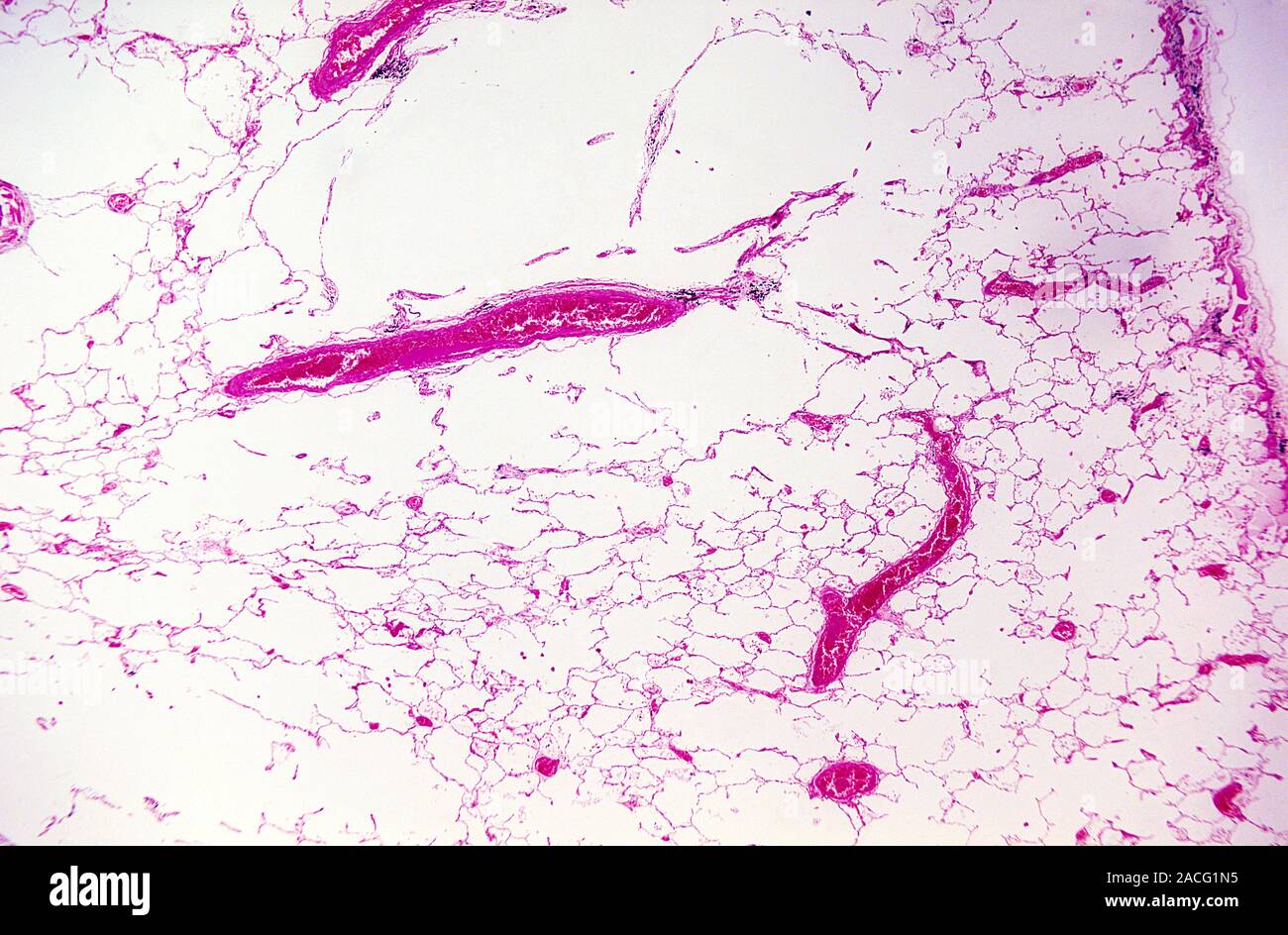 Emphysema. Light micrograph of a section through a lung with emphysema ...