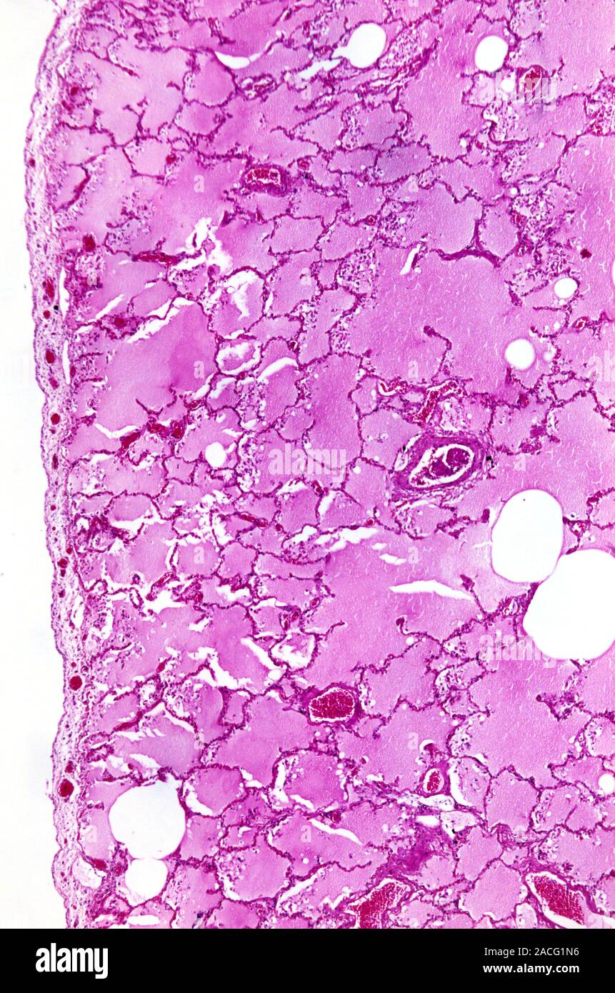 Pulmonary oedema. Light micrograph of a section through a lung with ...