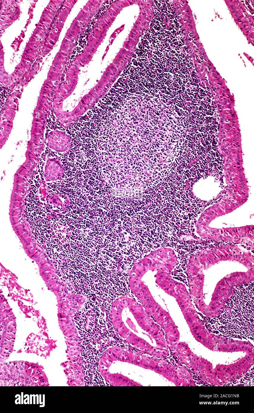 Salivary gland tumour. Light micrograph of a section through the ...