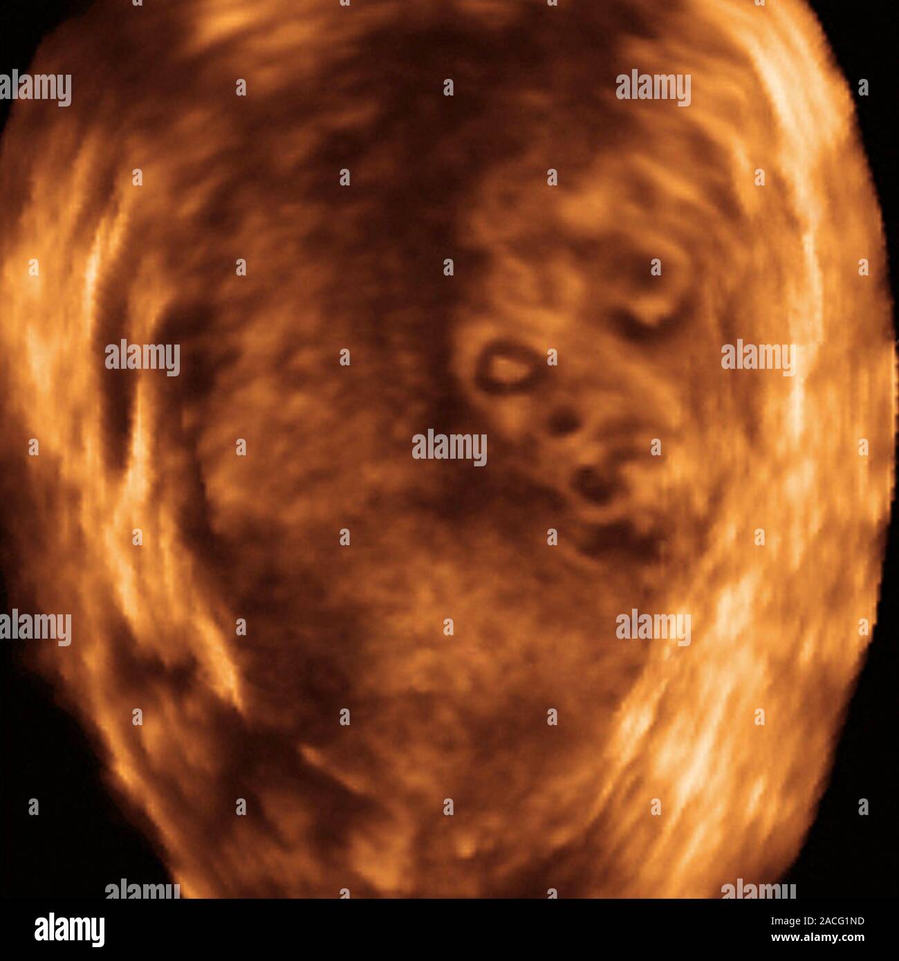Chorion cancer (choriocarcinoma). Coloured 3-D ultrasound scan of a ...