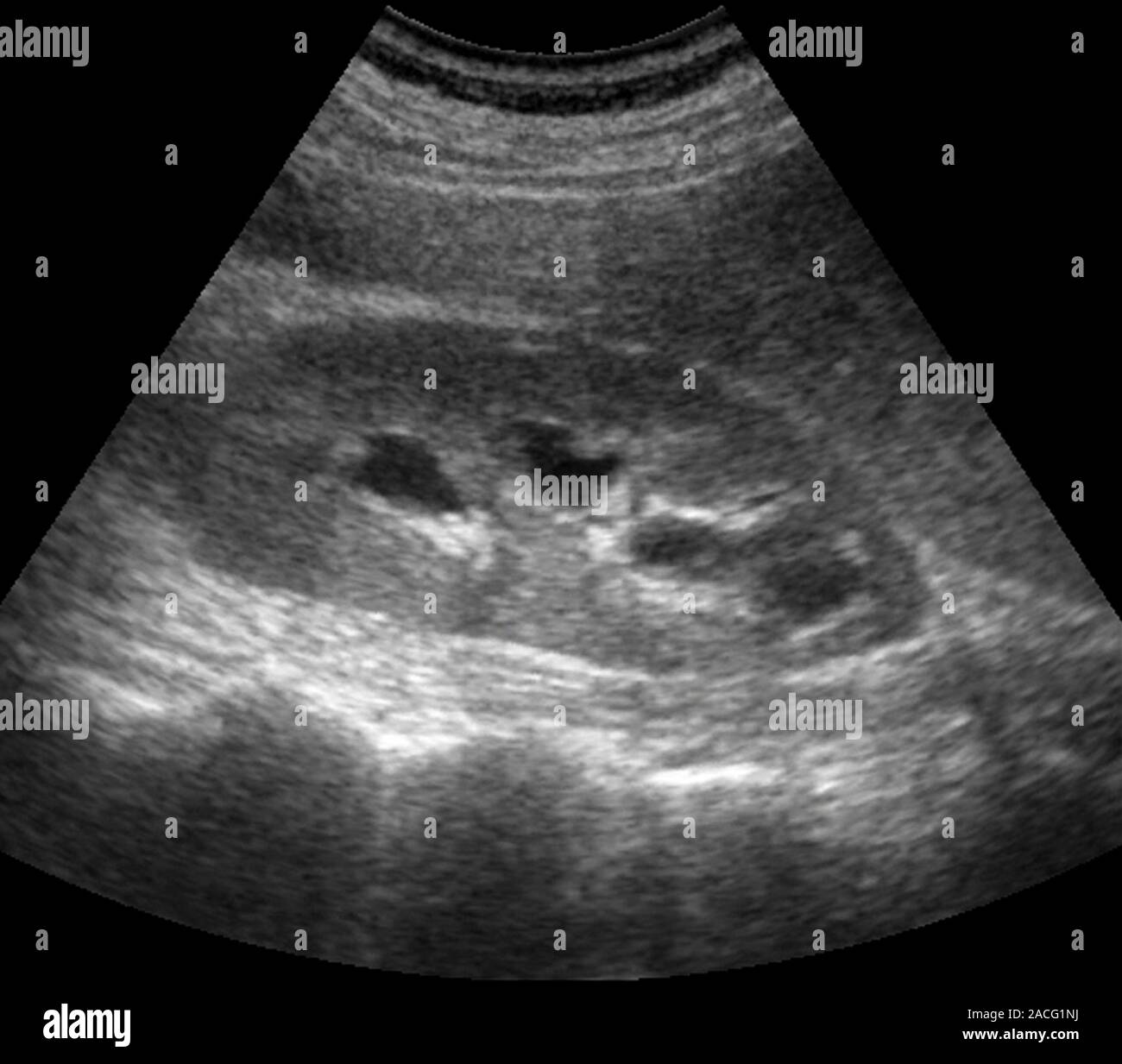 Enlarged kidney. Ultrasound scan of a kidney (centre) with ...