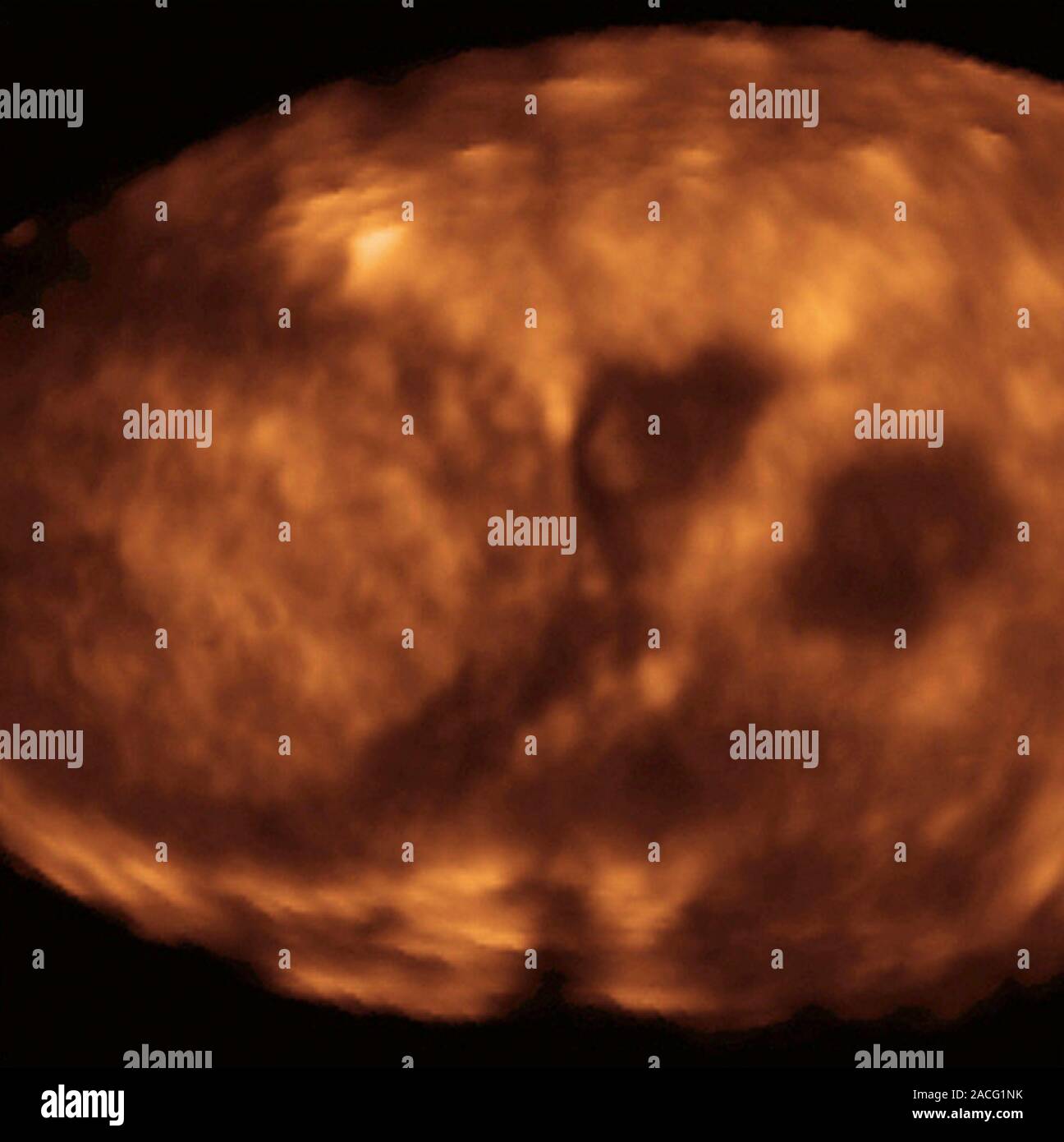 Ectopic pregnancy. Coloured 3-D ultrasound scan of an ectopic pregnancy ...