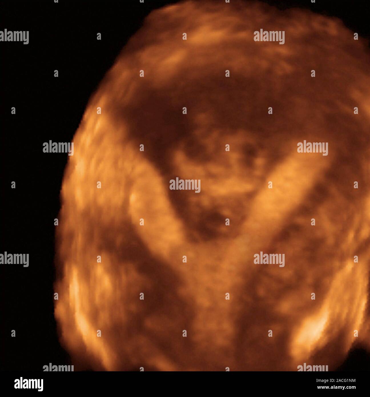 Uterine fibroid in a septated uterus. Coloured 3-D ultrasound scan of a ...