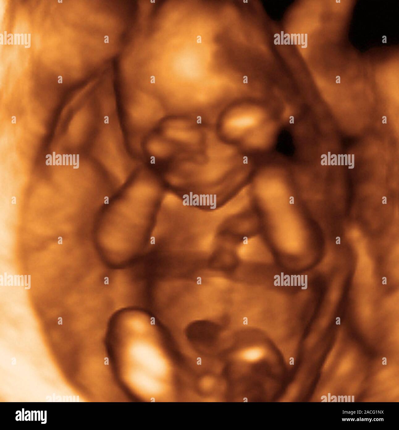 Foetus. Coloured 3-D ultrasound scan of a foetus holding its hands up ...