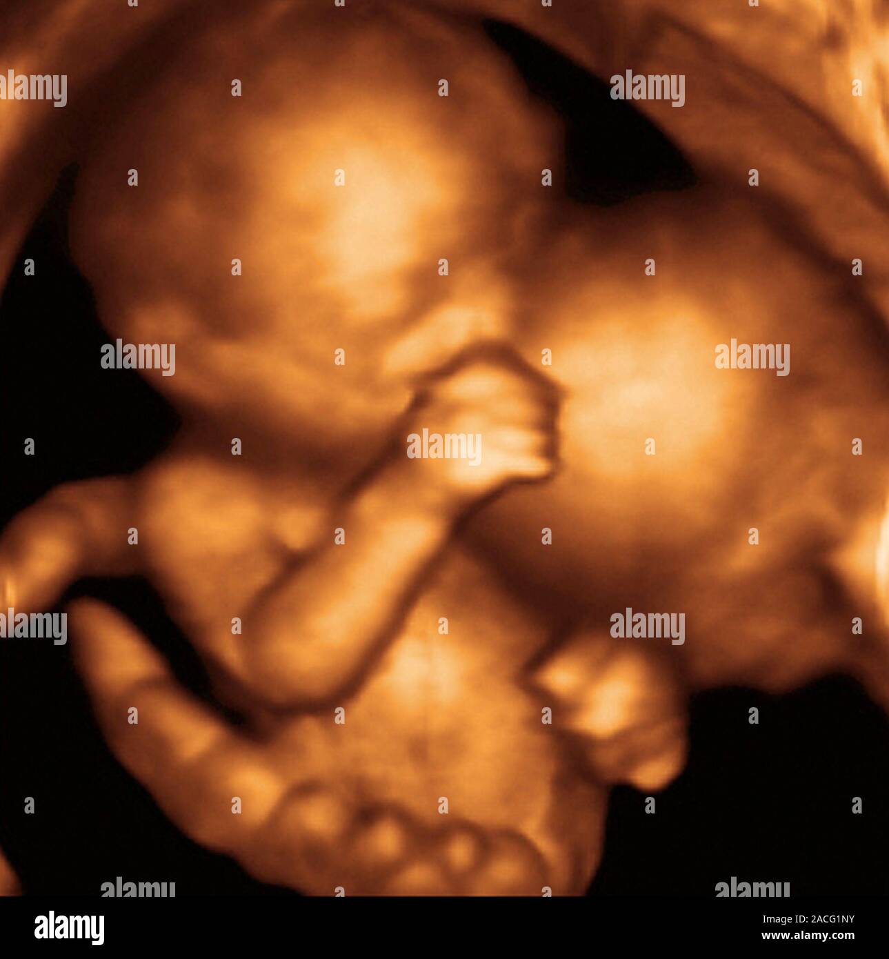 Foetus. Coloured 3-D ultrasound scan of a foetus holding its hand up in ...