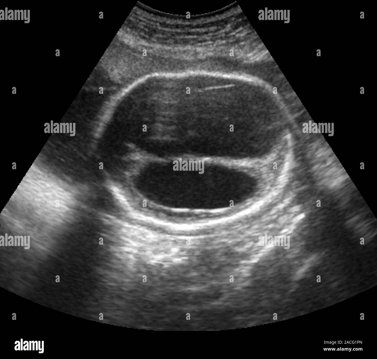 Abnormal foetus head, ultrasound scan. This foetus has hydrocephaly, a ...