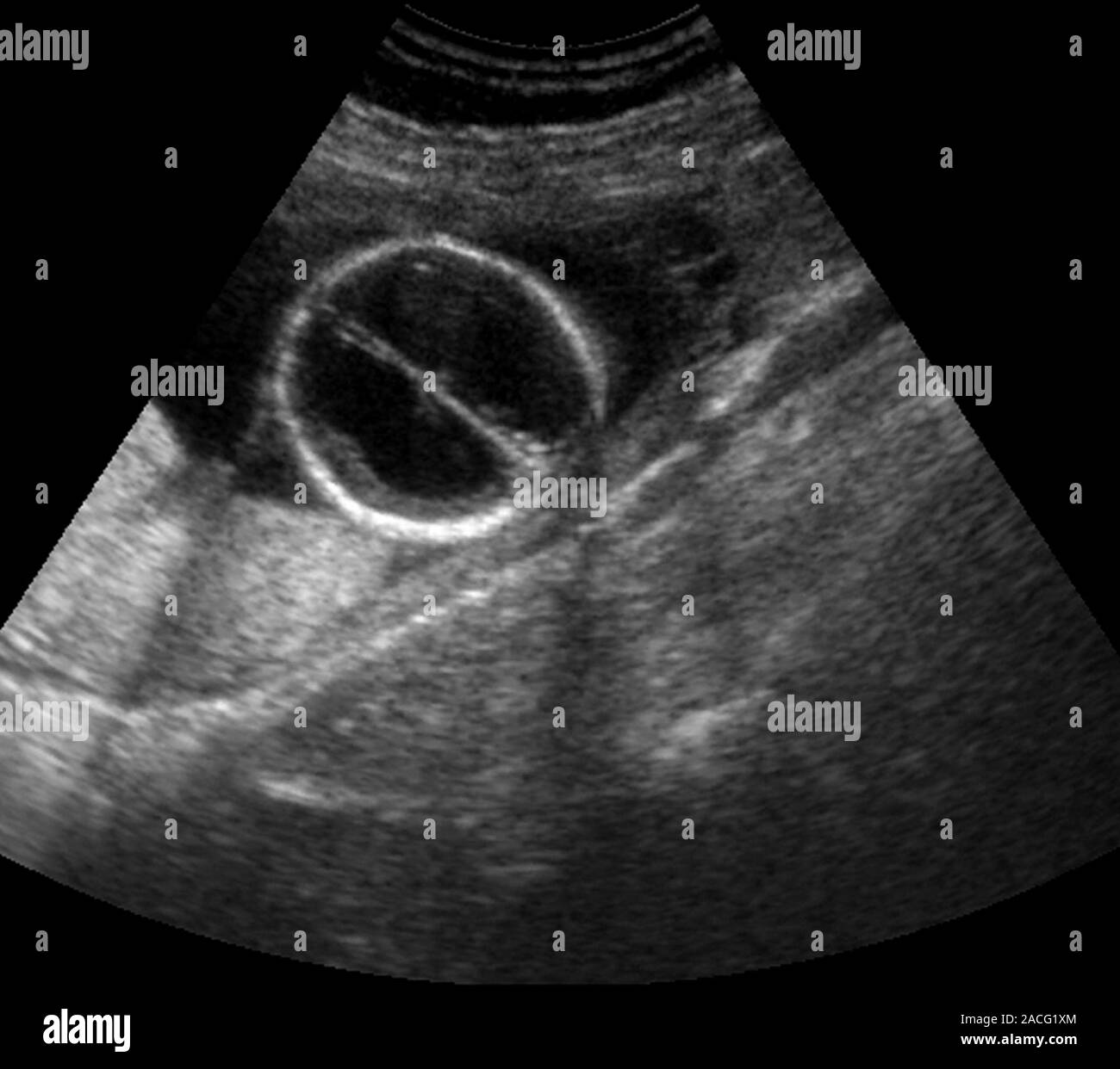 Abnormal foetus head, ultrasound scan. This foetus has hydrocephaly, a ...